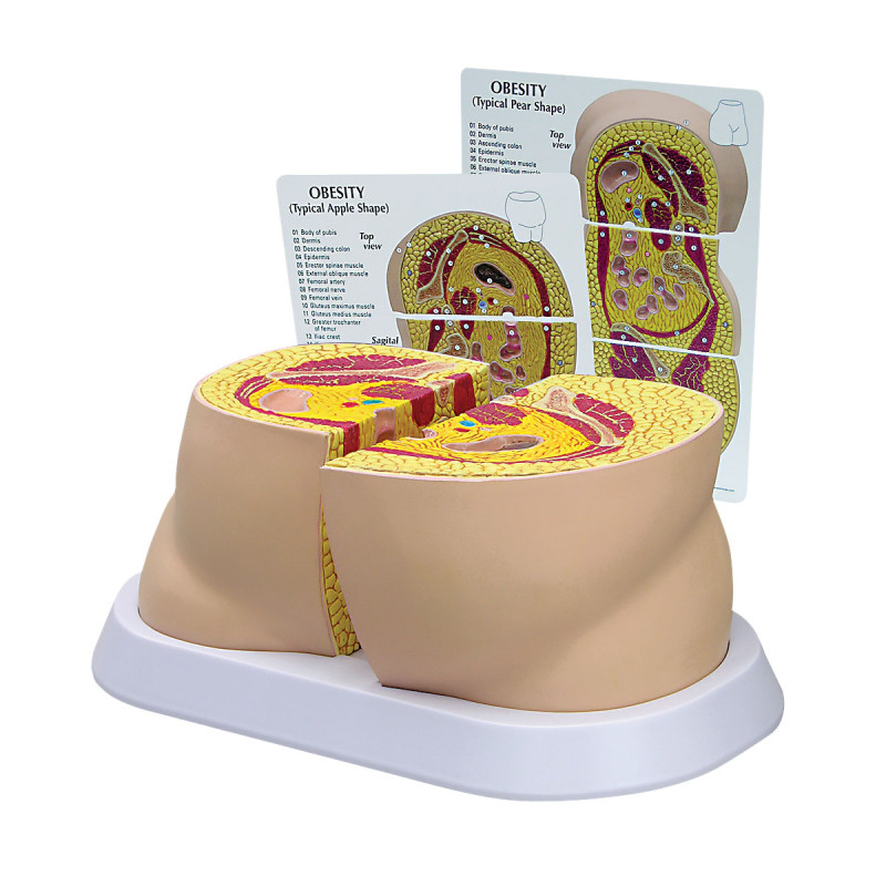 GPI Anatomicals 2-part obesity anatomy model | Medi-Shop.gr
