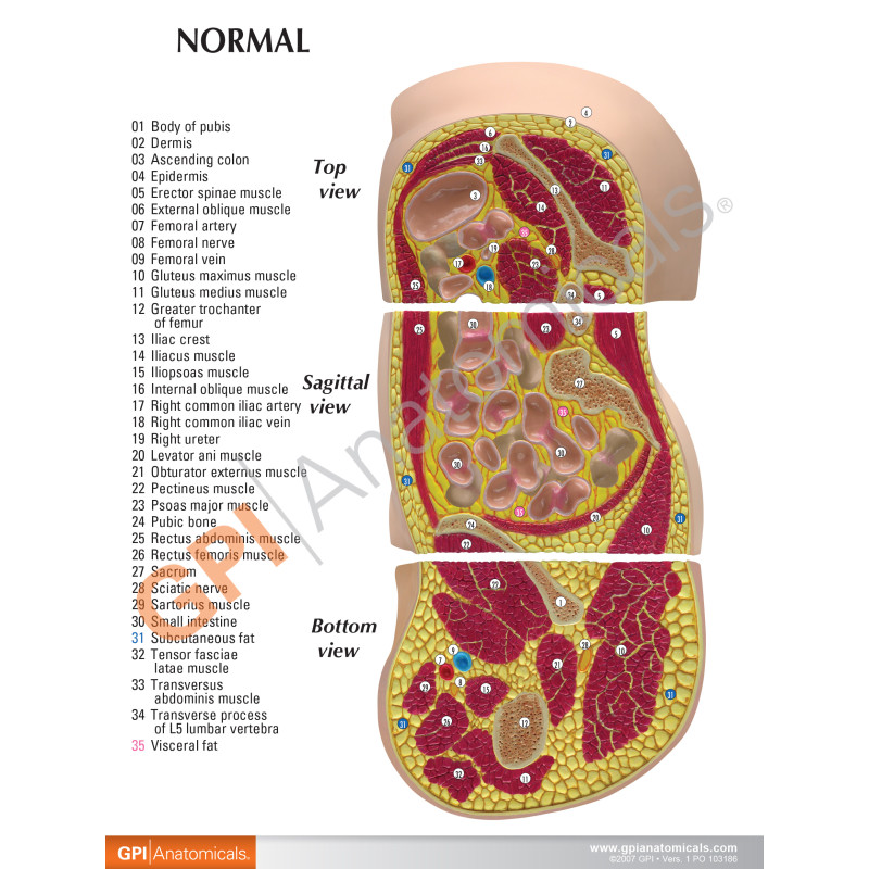 Πρόπλασμα παχυσαρκίας ισχίων 2 τμημάτων GPI Anatomicals | Medi-Shop.gr